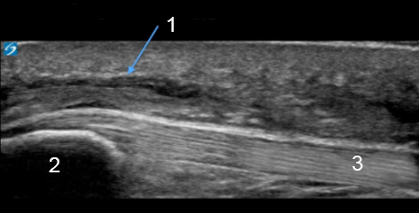 Prepatellar Bursitis Ultrasound